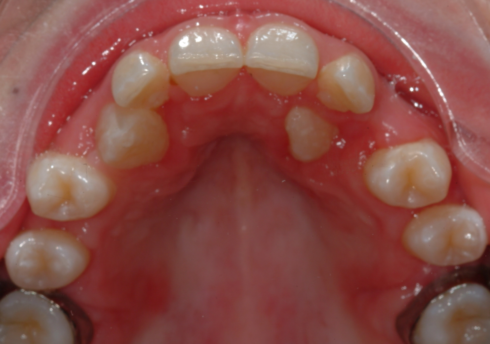 Unerupted Teeth - Bank Cottage Dental | Dentist in Thornbury, Bristol