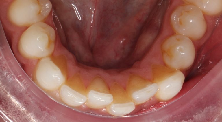 Mild Tooth Movement Relapse - Bank Cottage Dental | Dentist in ...