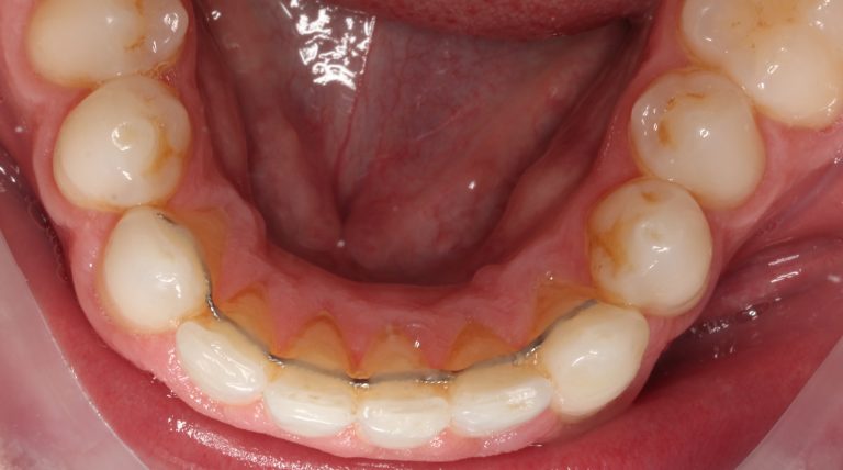 Mild Tooth Movement Relapse - Bank Cottage Dental | Dentist in ...