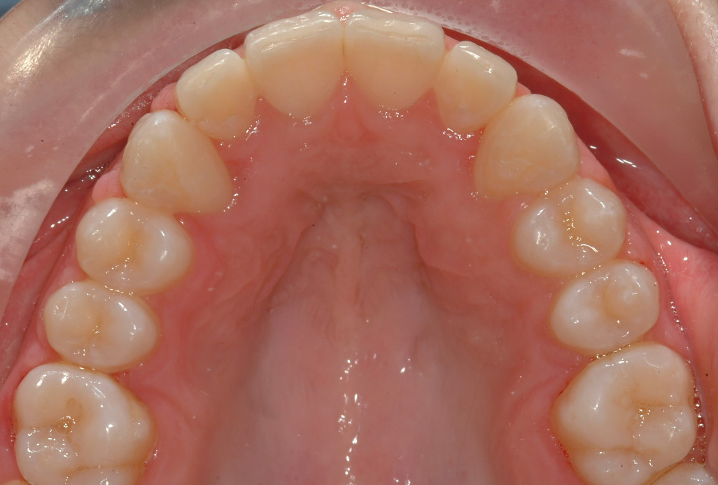 Unerupted Teeth - Bank Cottage Dental | Dentist in Thornbury, Bristol