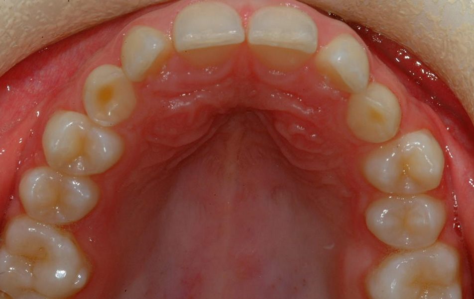 Unerupted Teeth - Bank Cottage Dental | Dentist in Thornbury, Bristol