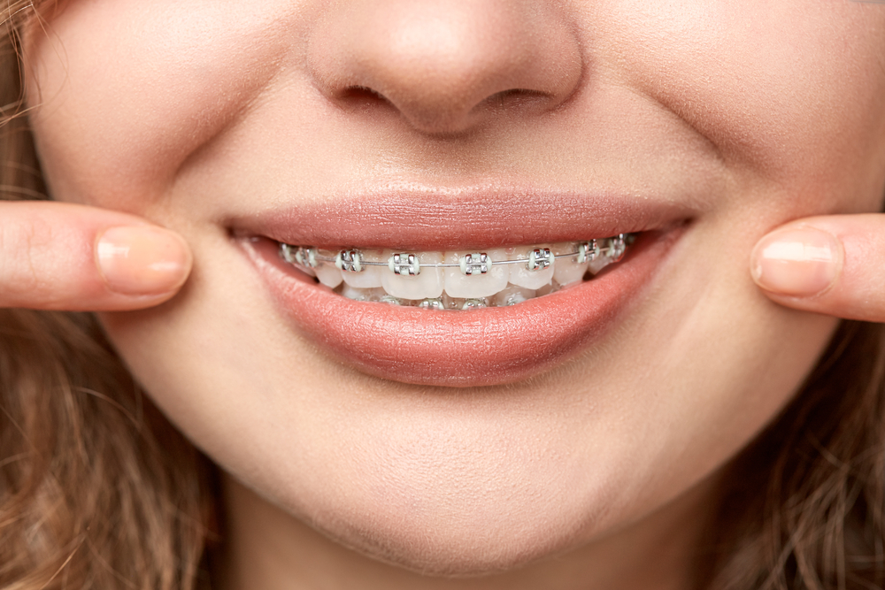 Metal Stainless Steel Braces Bank Cottage Dental Dentist In